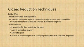 Mandibular fracture closed reduction | PPTX