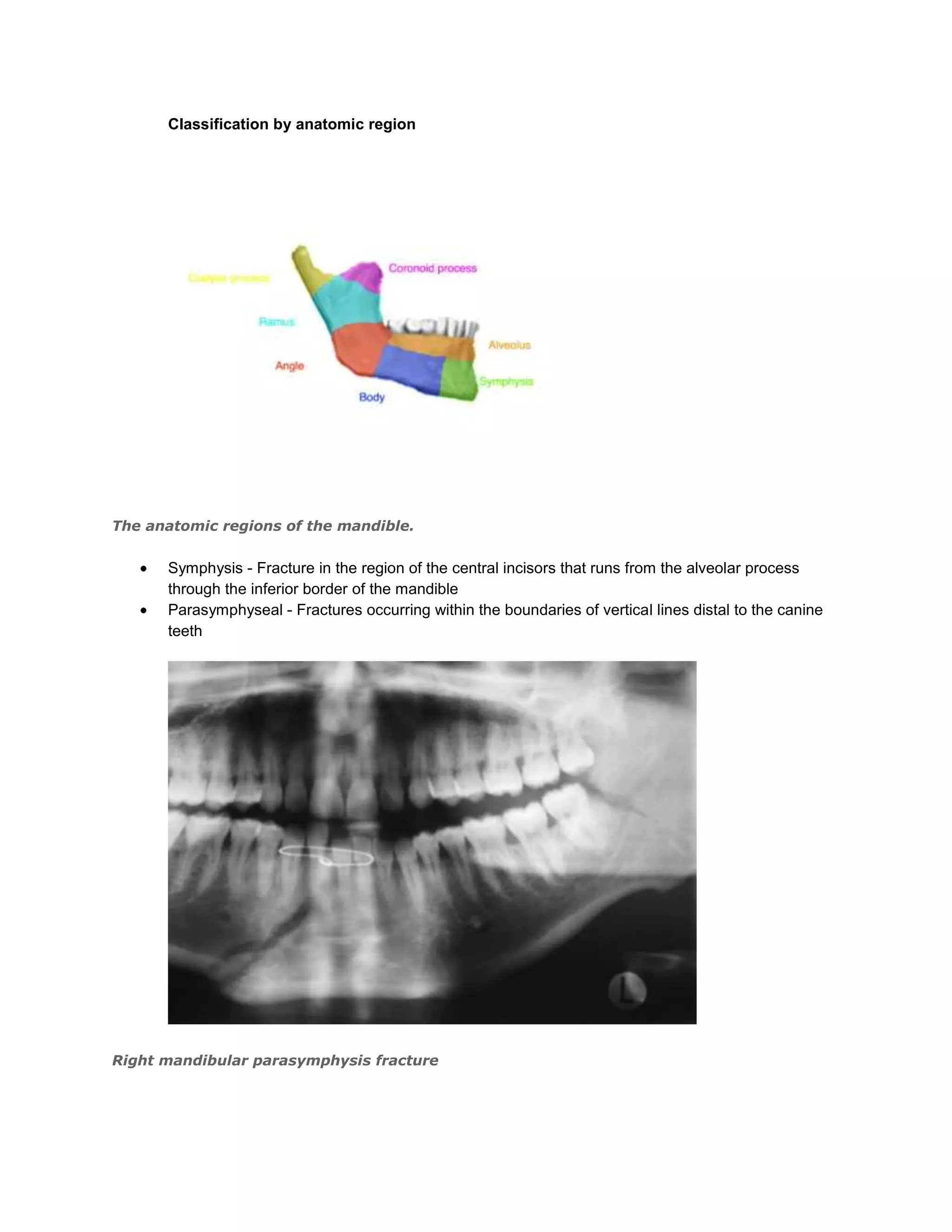 Mandibular fractures | DOCX | Death, Injury, or Military Conflict ...