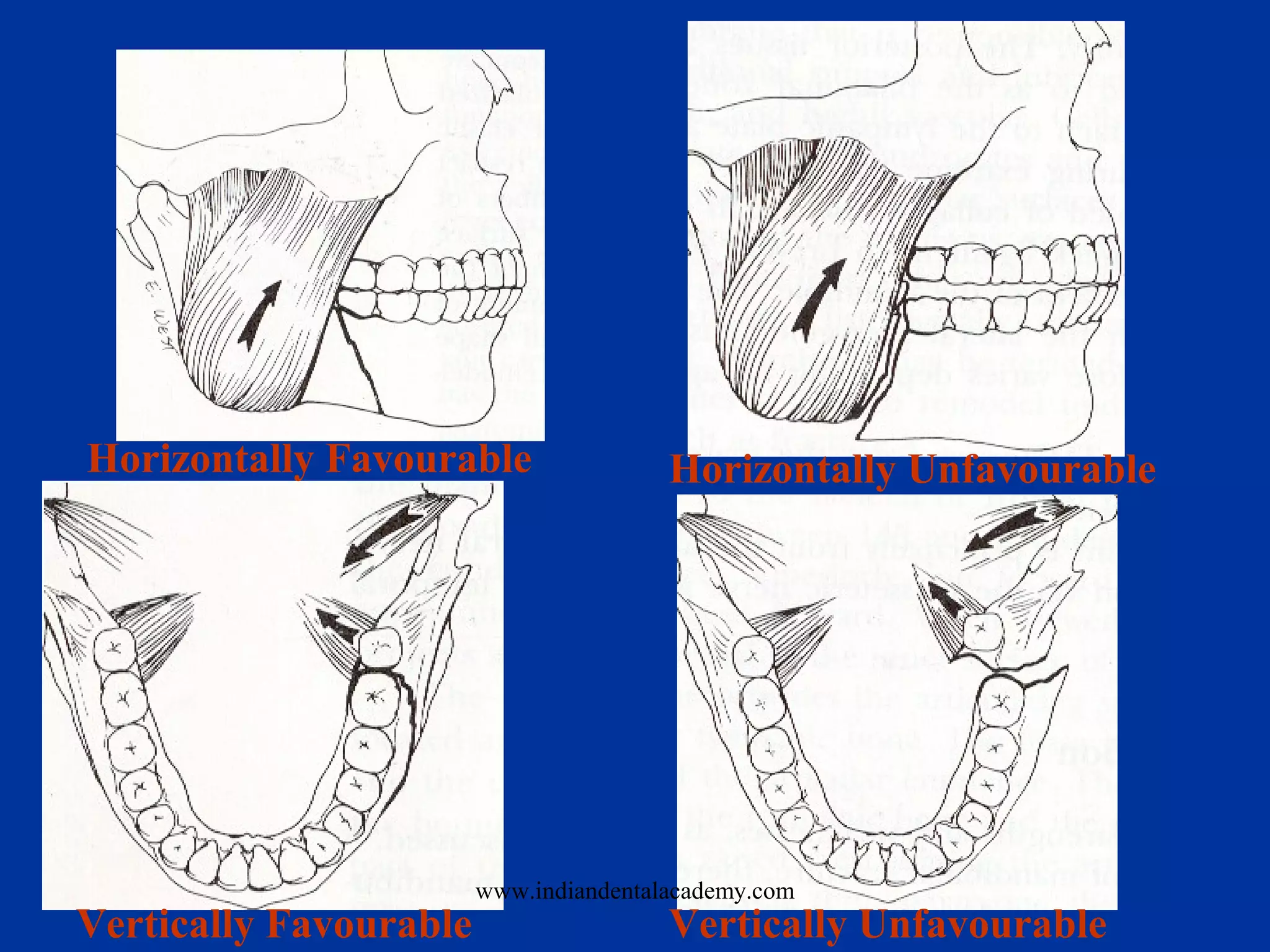 Mandibular fractures / oral surgery courses | PPT