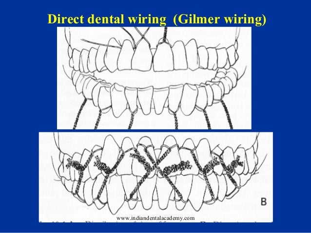 Mandibular fractures / oral surgery courses