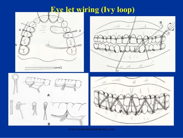 Mandibular fractures / oral surgery courses