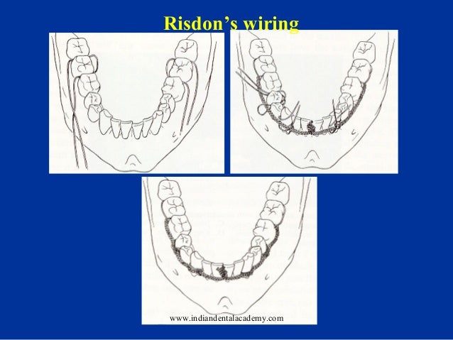 Mandibular fractures / oral surgery courses