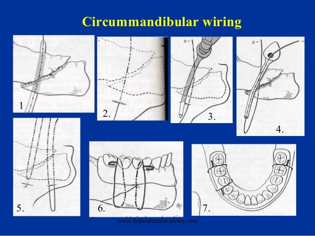 Mandibular fractures / oral surgery courses