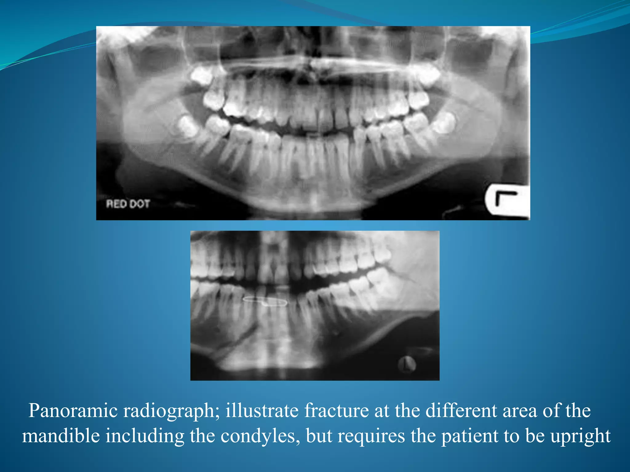 Mandibular fractures | PPTX