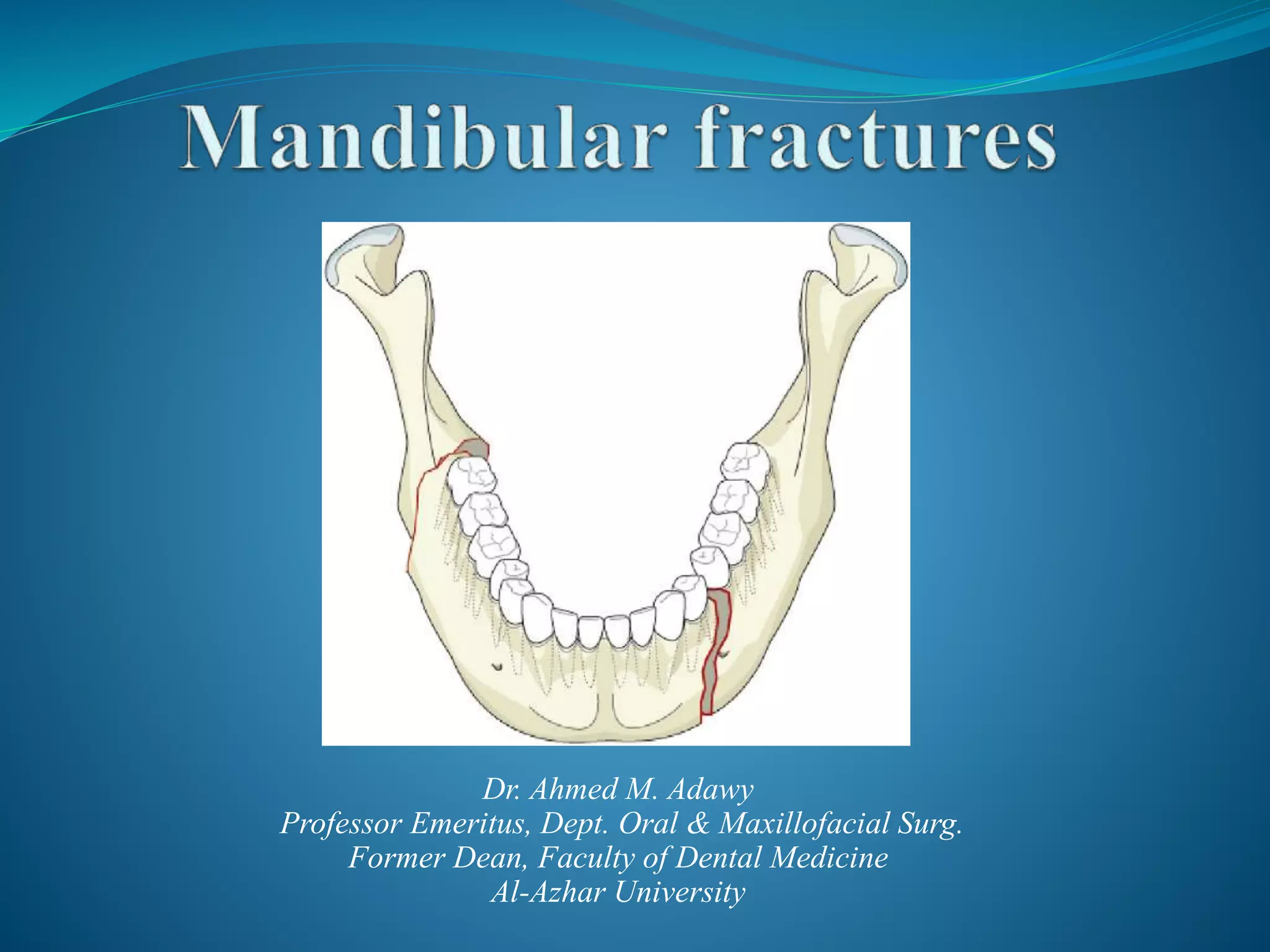 Mandibular fractures | PPTX