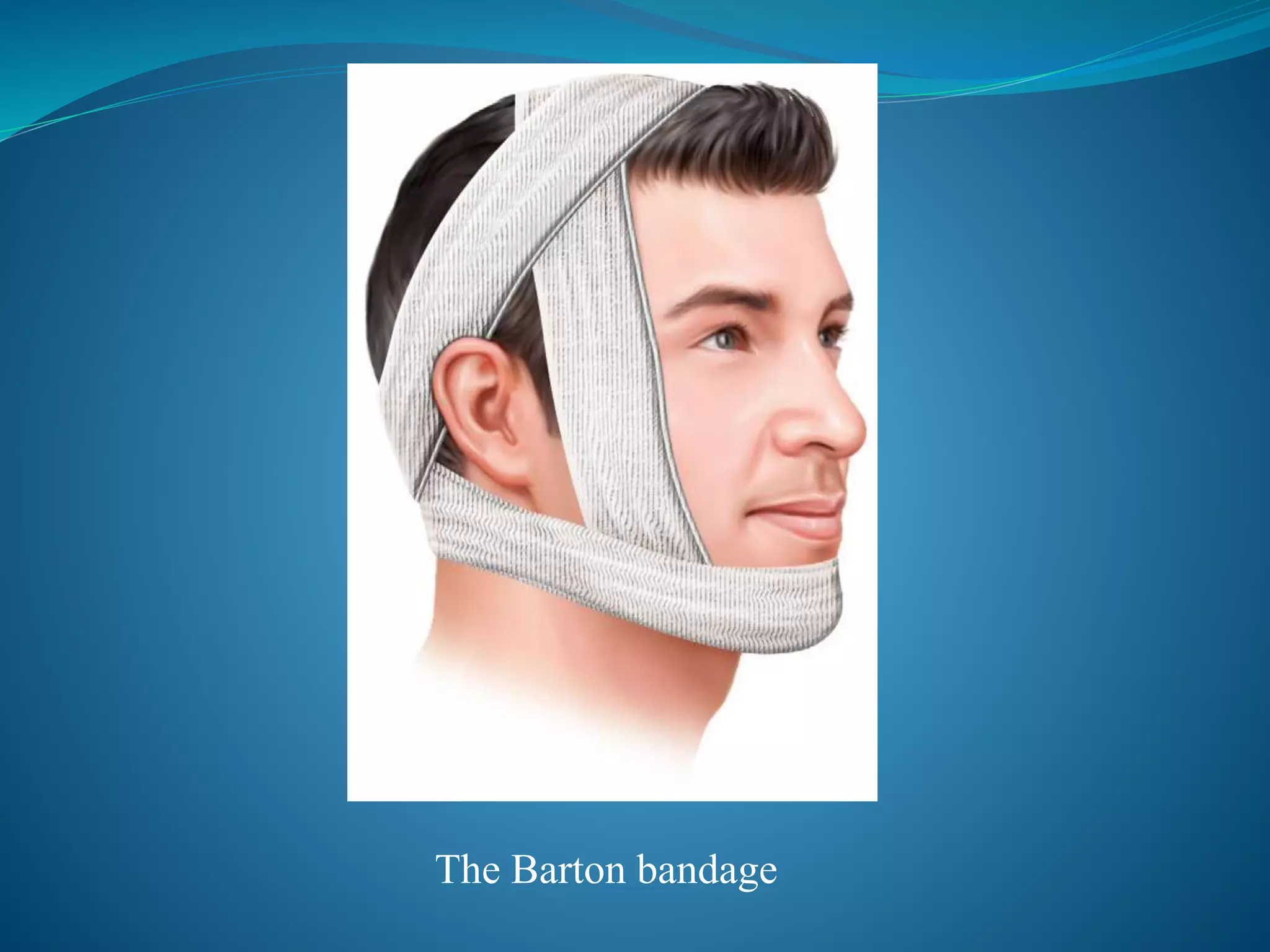 Mandibular fractures | PPTX