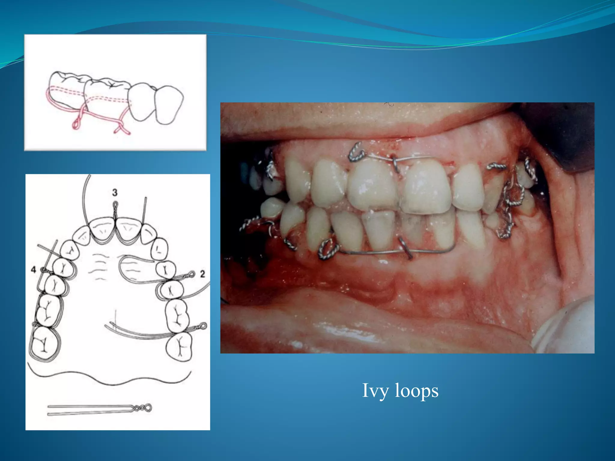 Mandibular fractures | PPTX