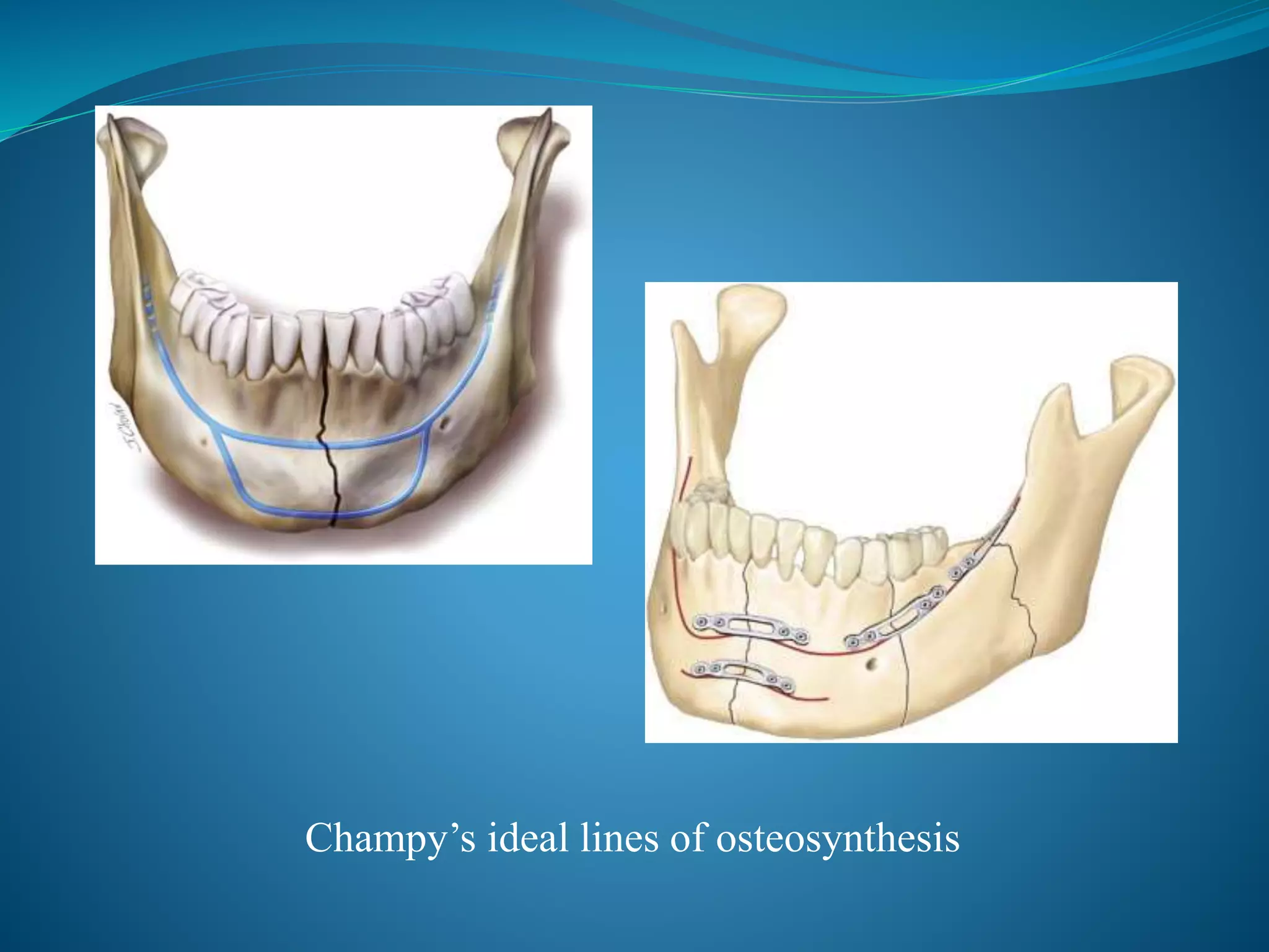Mandibular fractures | PPTX