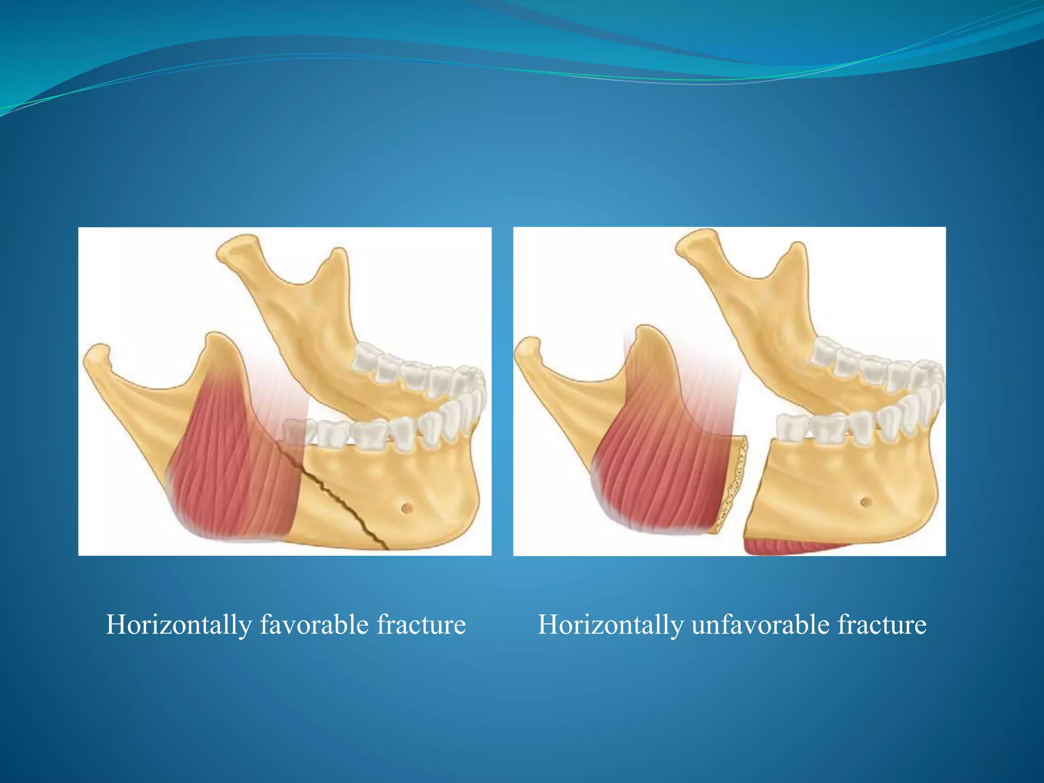 Mandibular fractures | PPTX
