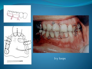 Mandibular fractures | PPTX