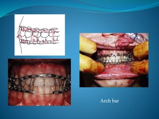 Mandibular fractures | PPTX