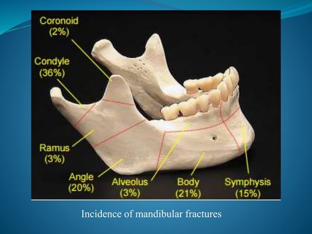Mandibular fractures | PPTX