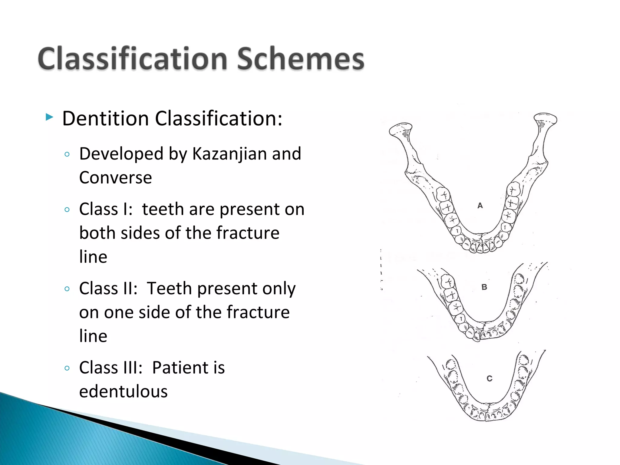 Mandibular fractures | PPT