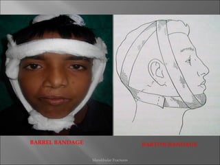 Mandibular fractures ih | PPT