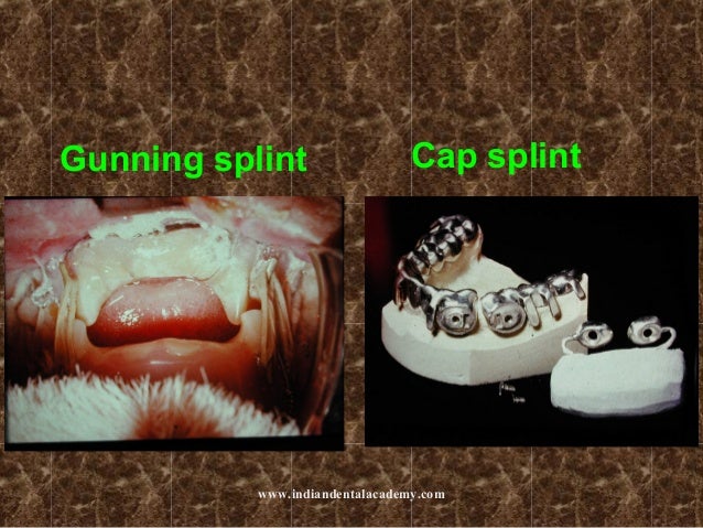 Mandibular fractures / fixed orthodontic courses
