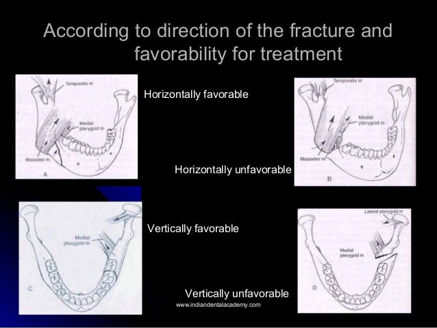 Mandibular fractures 1 / fixed orthodontic courses