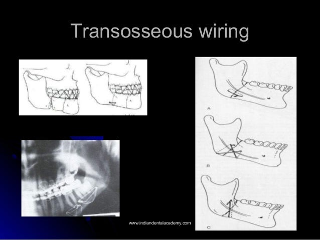 Mandibular fractures 1 / fixed orthodontic courses