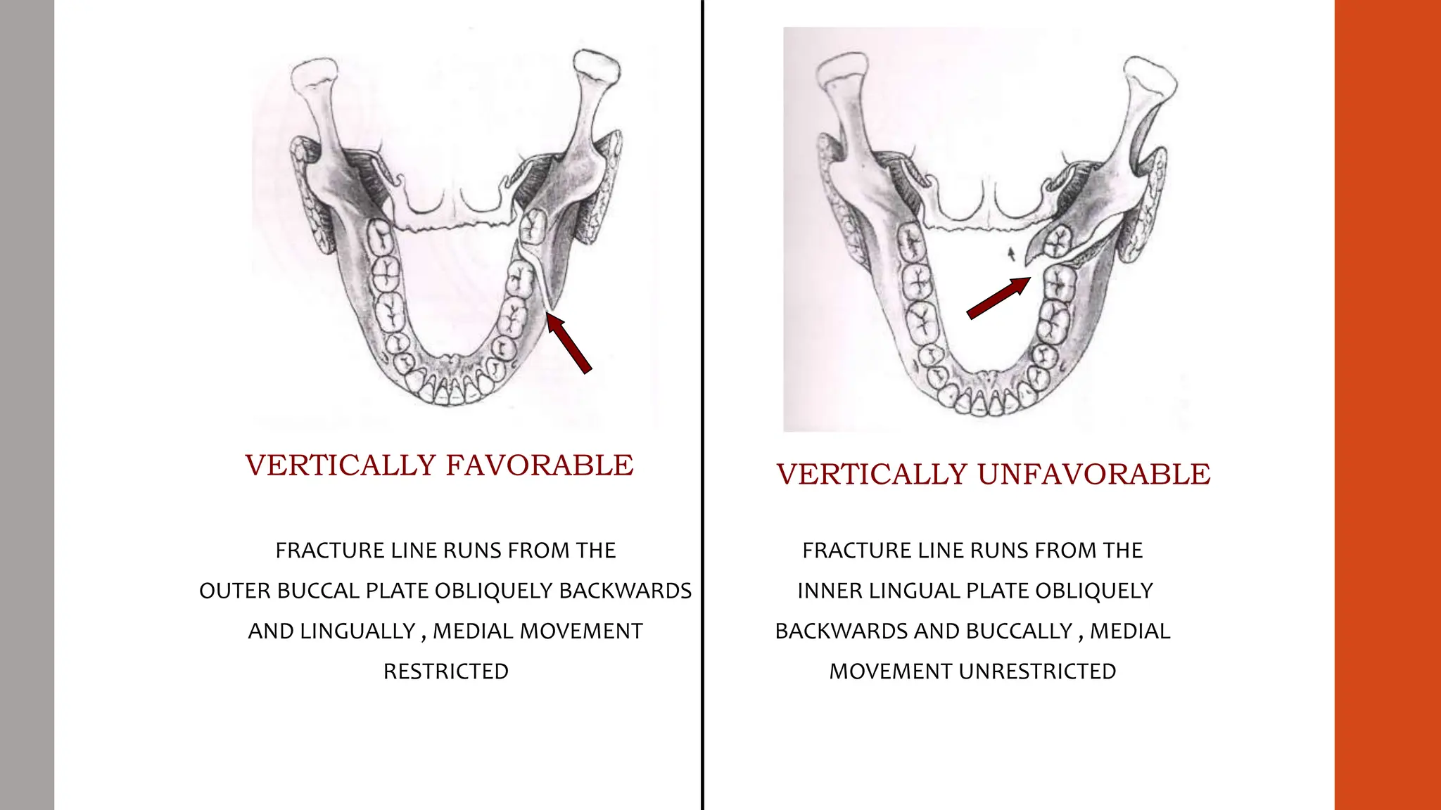 MANDIBULAR FRACTURES MANAGEMENT PROTOCO | PPTX