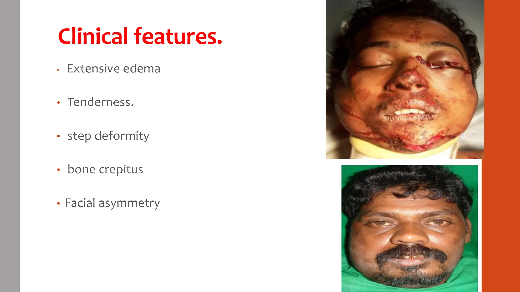 MANDIBULAR FRACTURES MANAGEMENT PROTOCO | PPTX