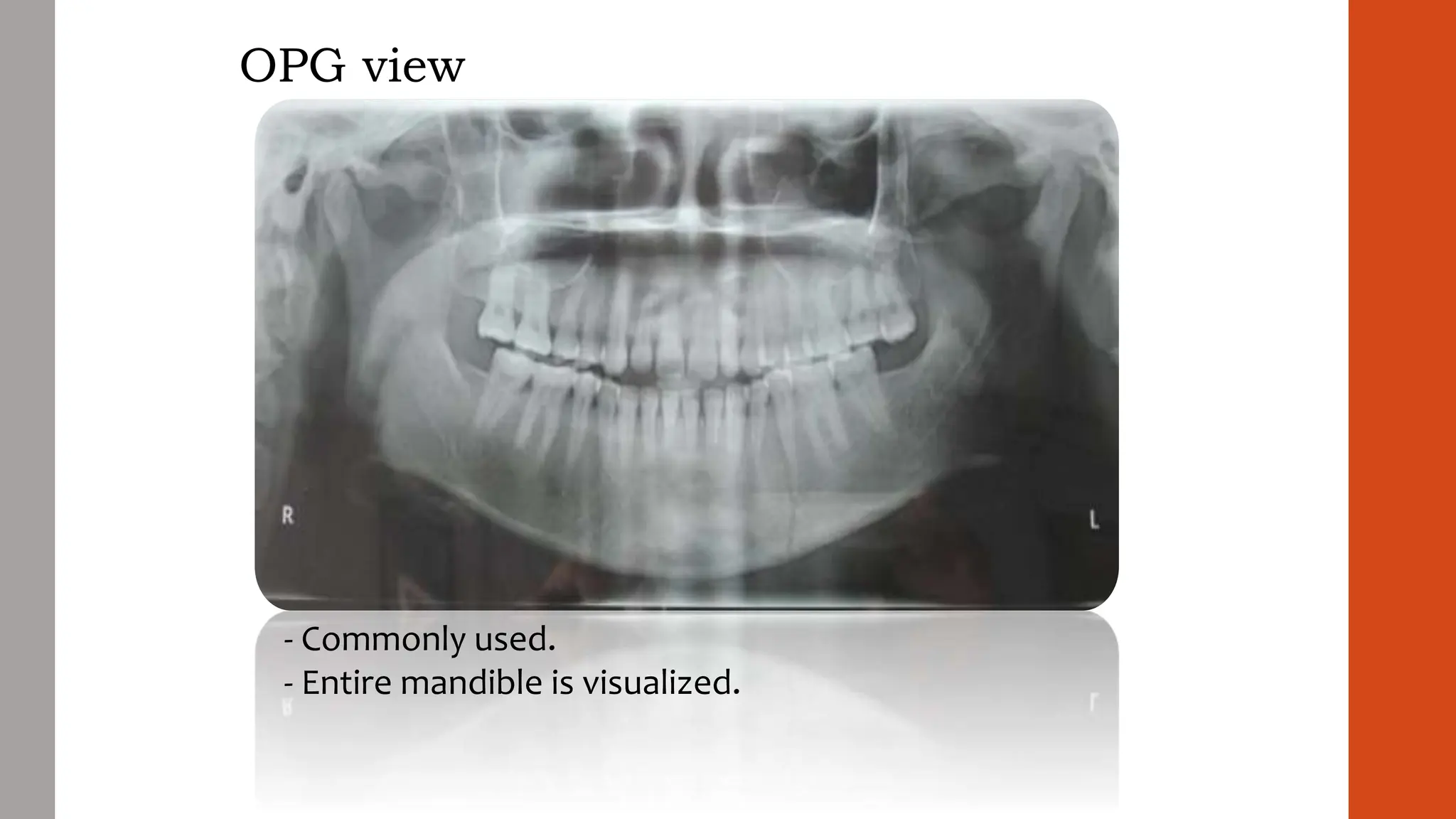 MANDIBULAR FRACTURES MANAGEMENT PROTOCO | PPTX