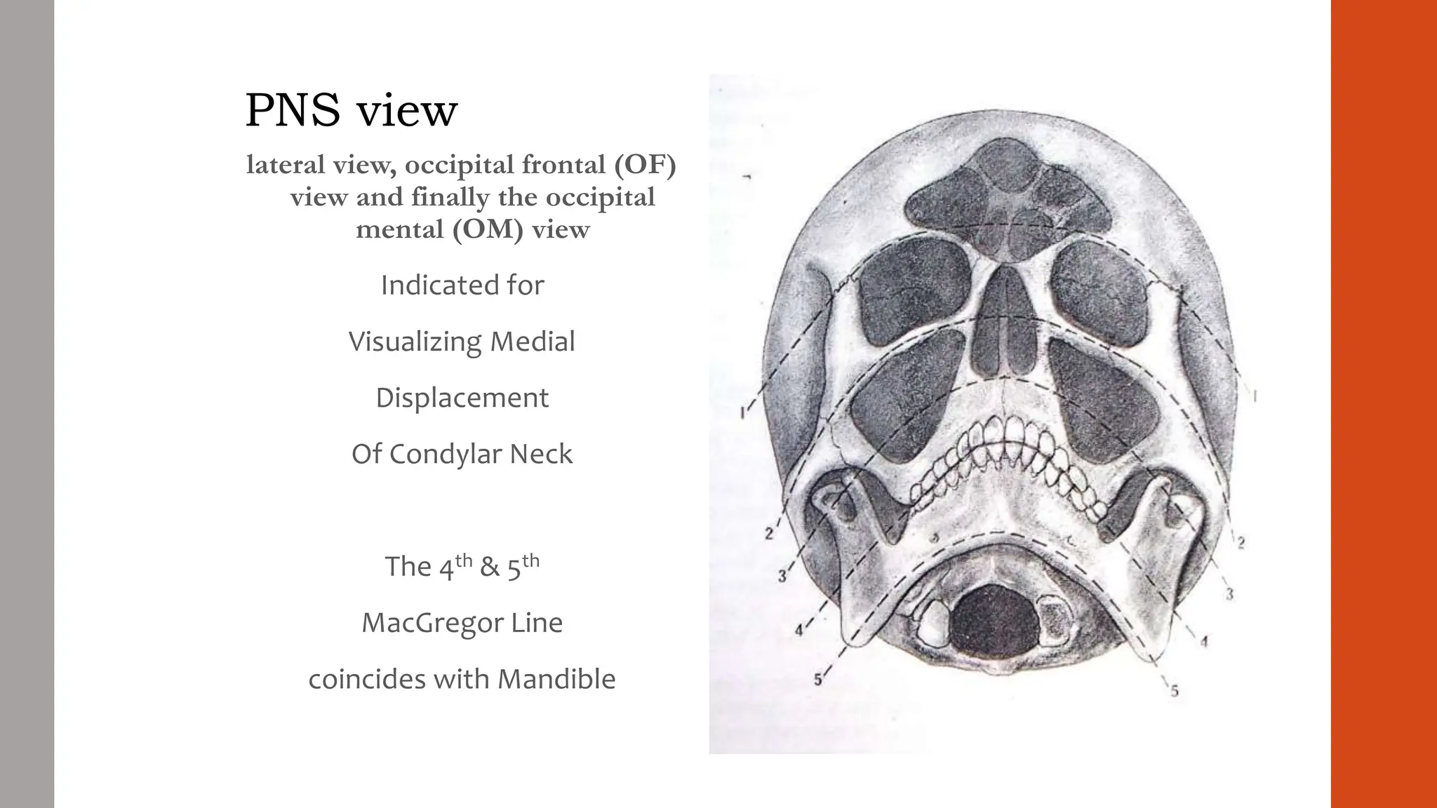 MANDIBULAR FRACTURES MANAGEMENT PROTOCO | PPTX