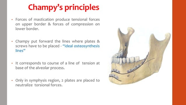 MANDIBULAR FRACTURES MANAGEMENT PROTOCO | PPTX | Death, Injury, or ...