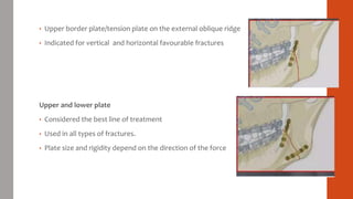 MANDIBULAR FRACTURES MANAGEMENT PROTOCO | PPTX