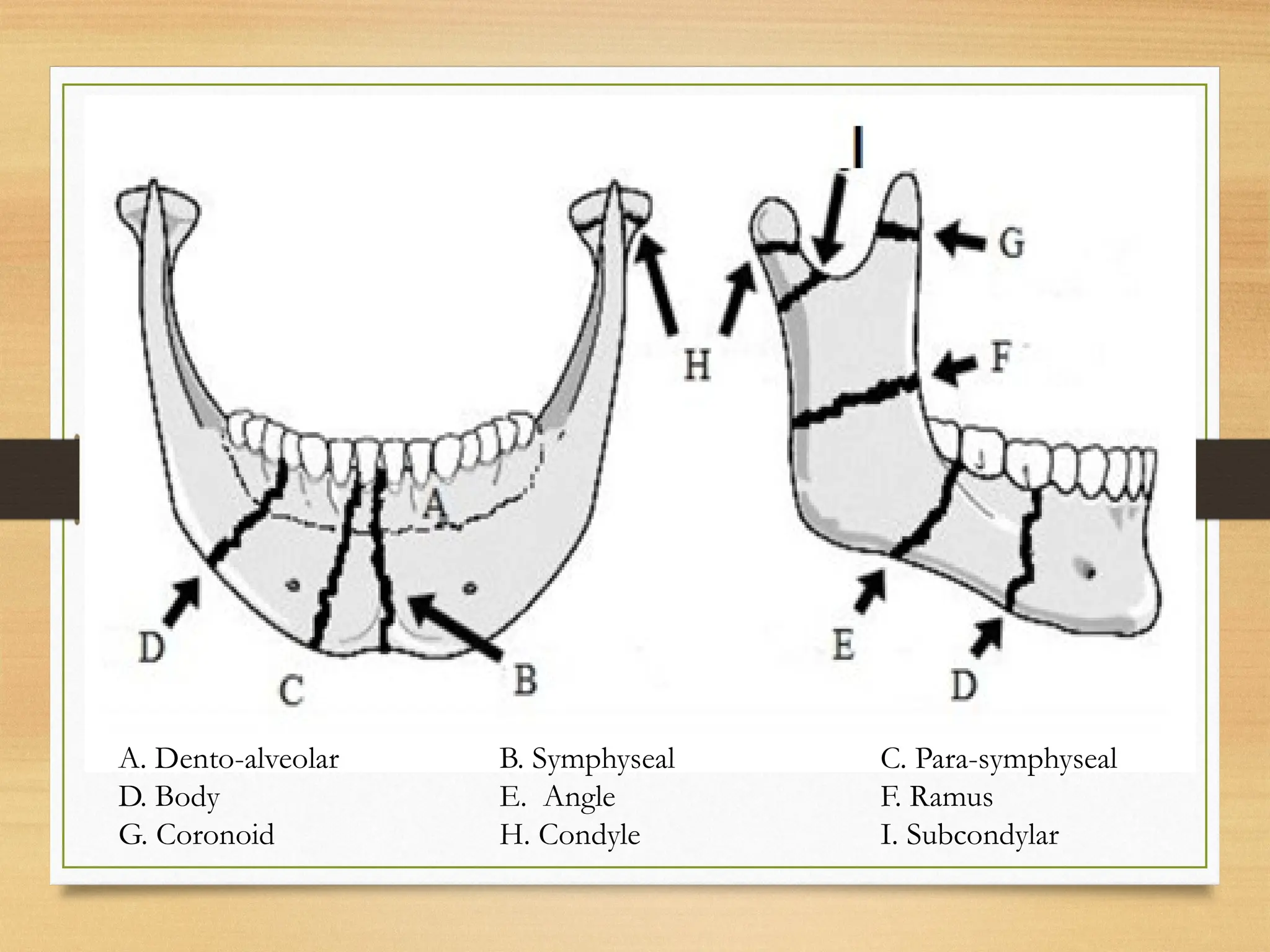 Mandibular fractures classification, management | PPTX