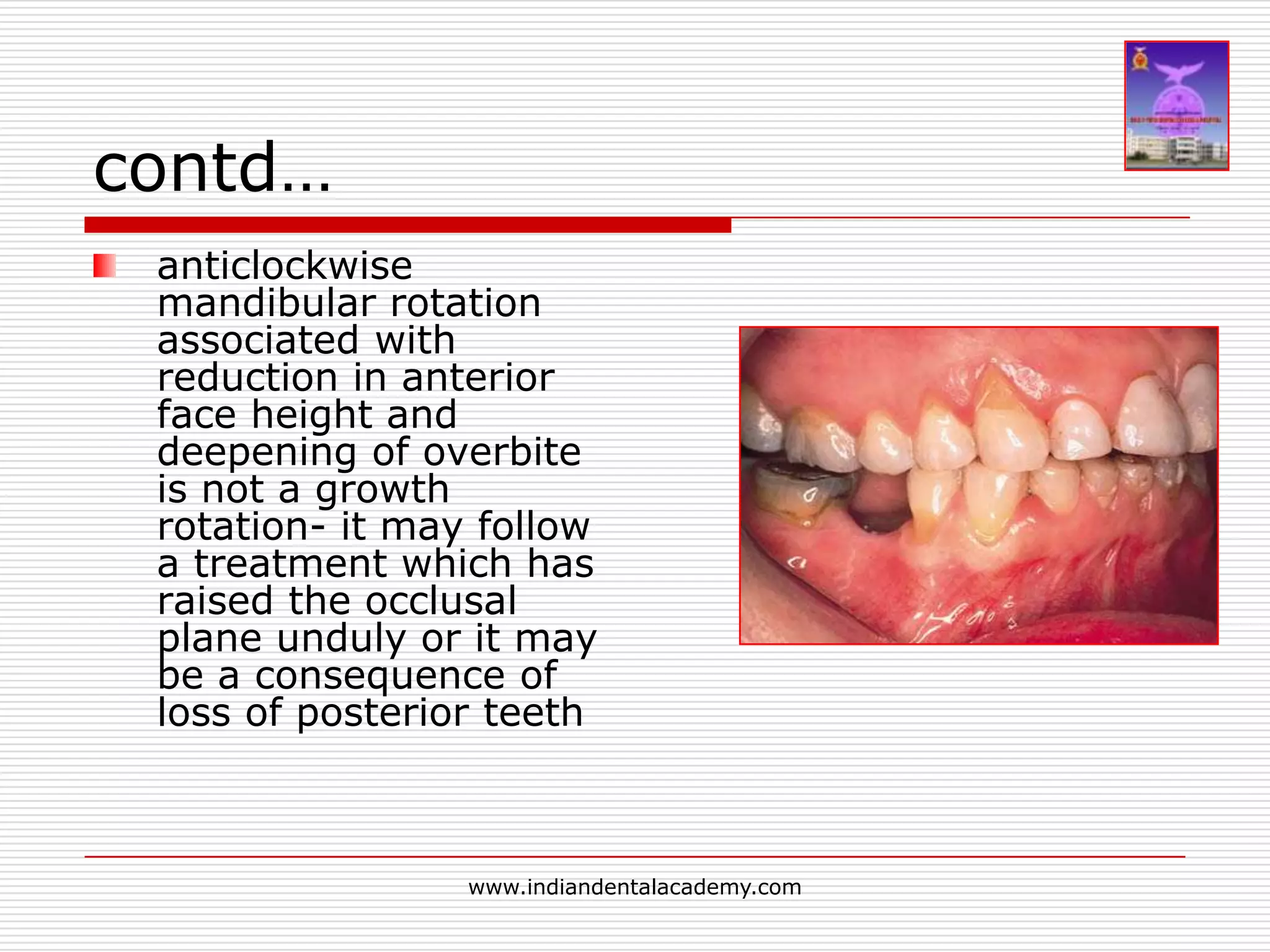 Mandibular growth rotation (2)/certified fixed orthodontic courses by ...
