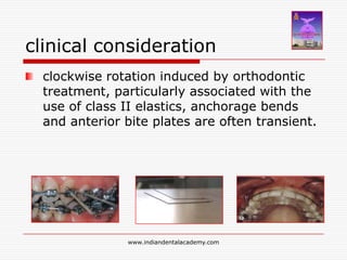 Mandibular growth rotation (2)/certified fixed orthodontic courses by ...