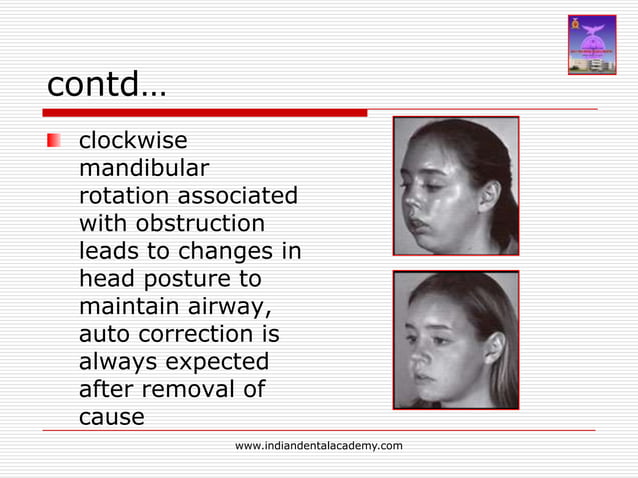 Mandibular growth rotation (2)/certified fixed orthodontic courses by ...