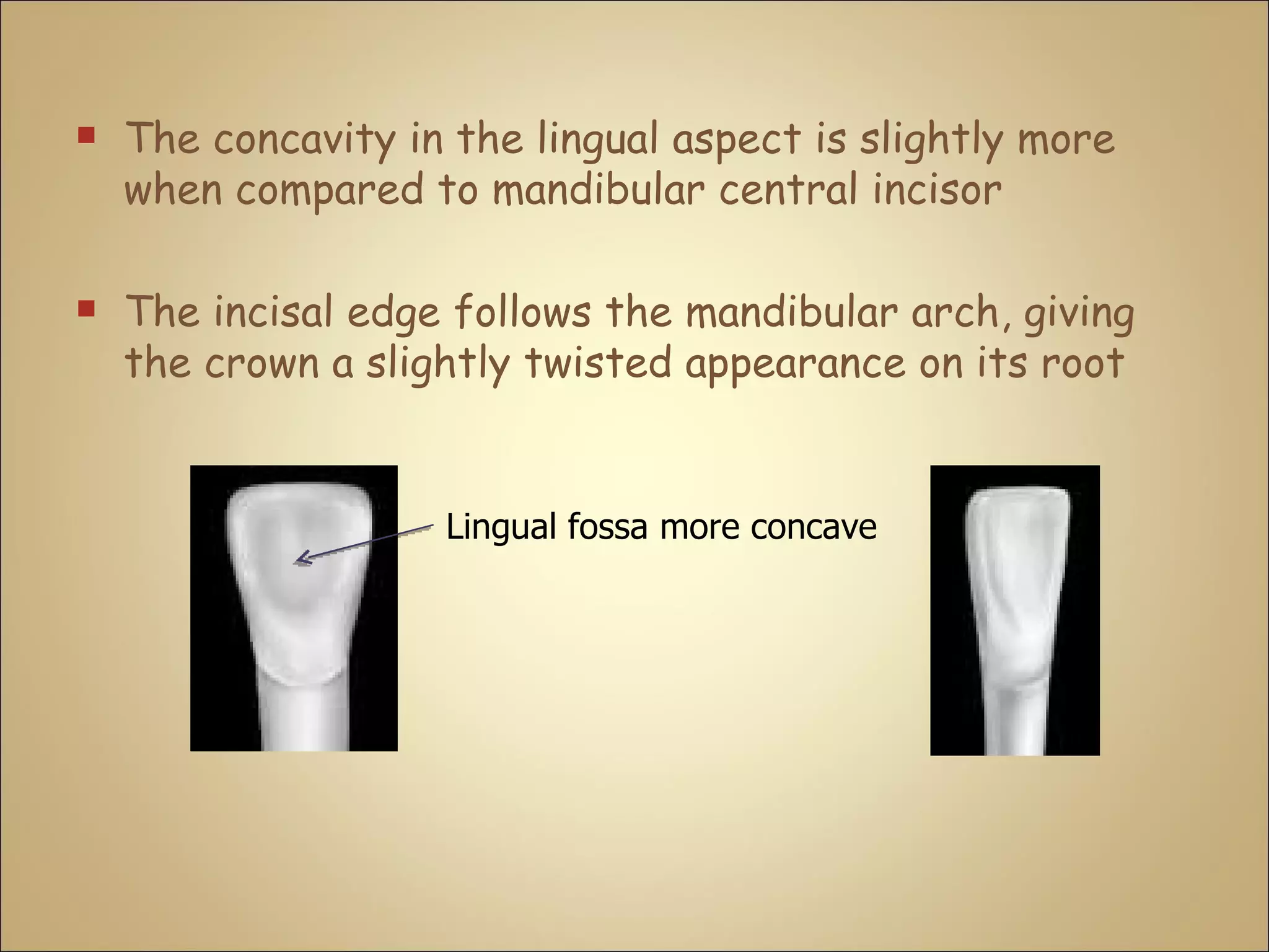 Mandibular Incisors | PPT | Free Download