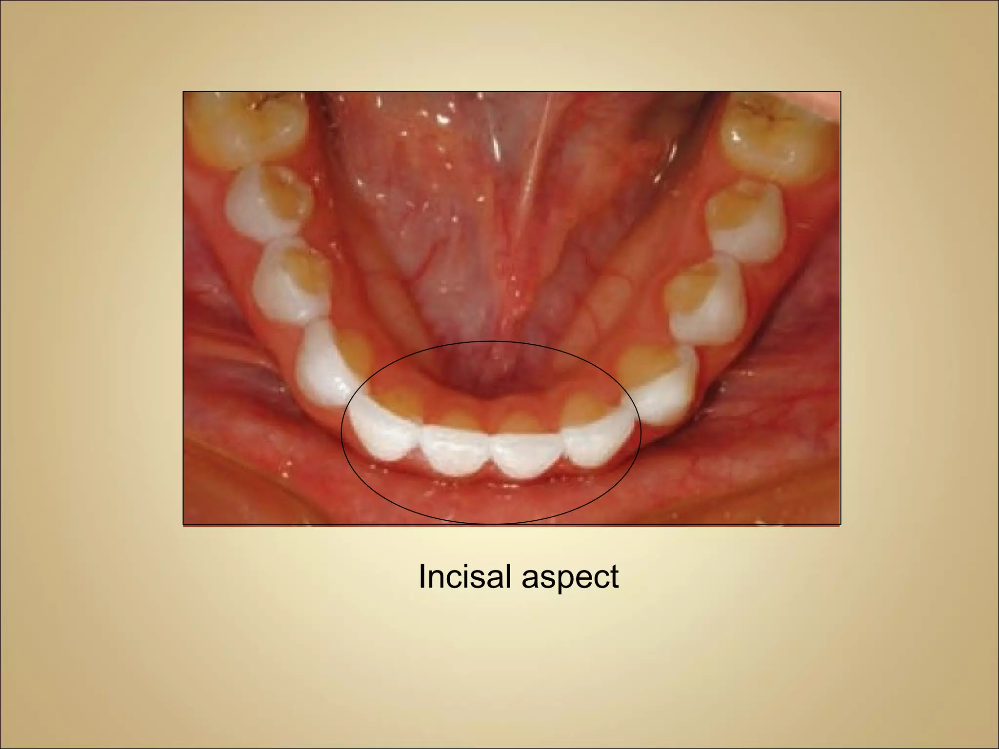 morphology of mandibular central and lateral incisors teeth | PPT