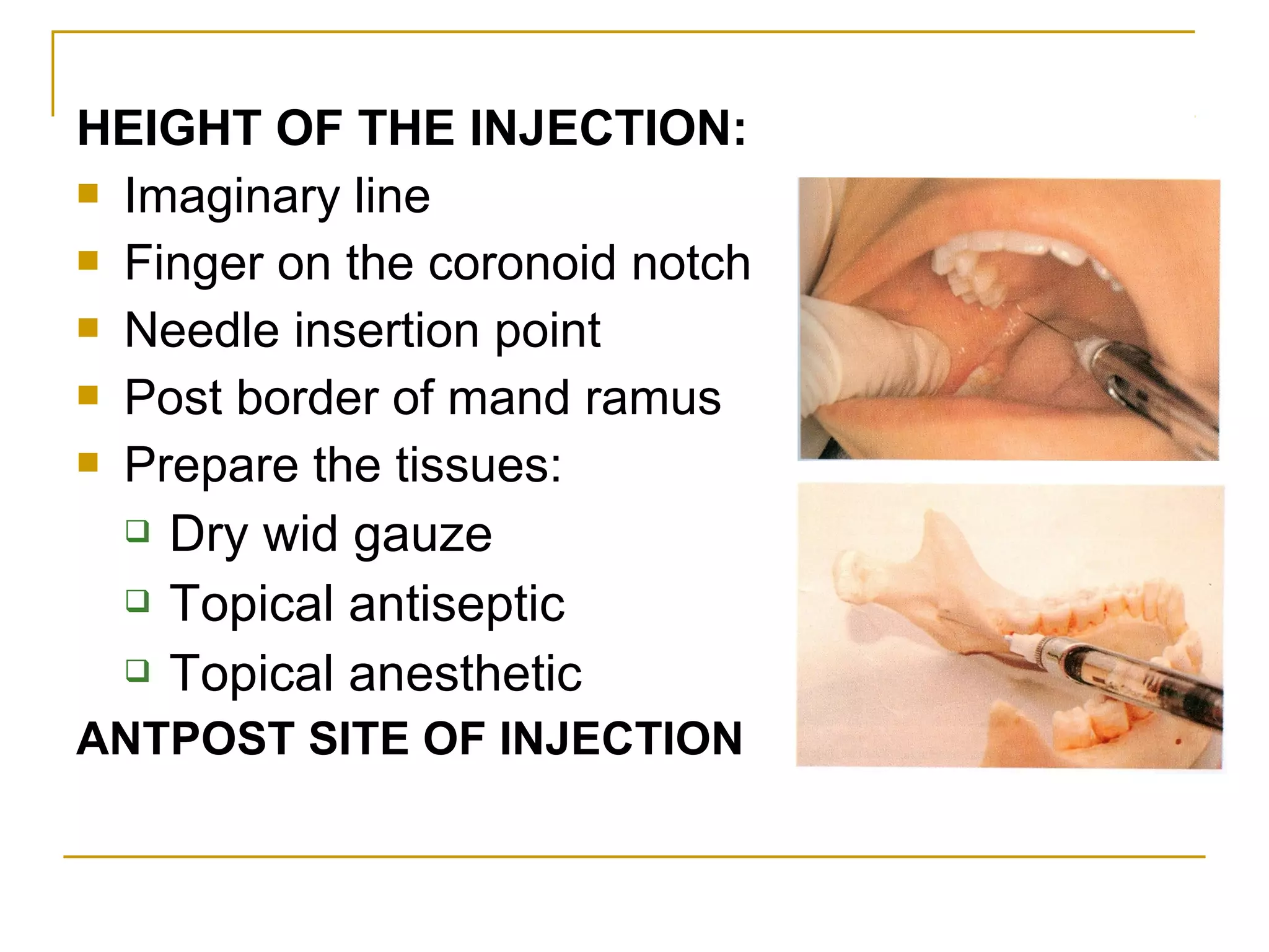 Mandibular Injection Technique | PPT