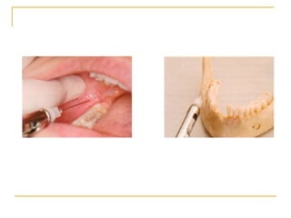 Mandibular Injection Technique | PPT