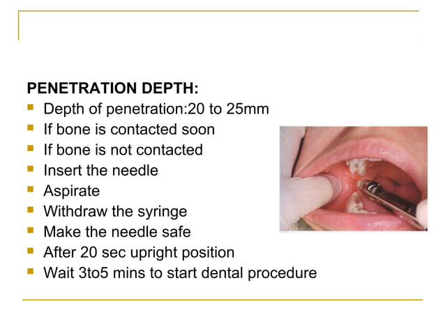 Mandibular Injection Technique | PPT | Ear, Nose and Throat Conditions ...