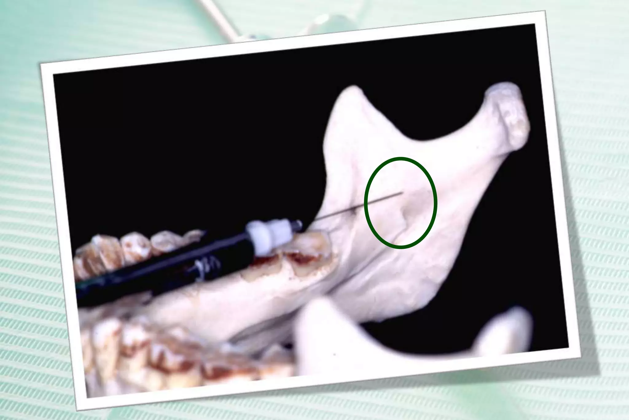 Mandibular injections | PPTX | Ear, Nose and Throat Conditions ...