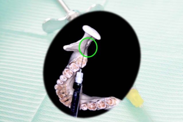 Mandibular injections | PPTX | Ear, Nose and Throat Conditions ...