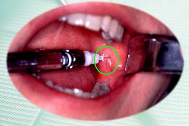 Mandibular injections | PPTX | Ear, Nose and Throat Conditions ...