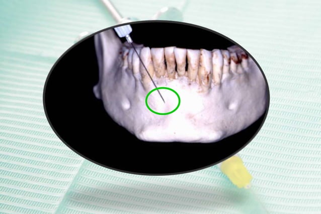 Mandibular injections | PPTX | Ear, Nose and Throat Conditions ...