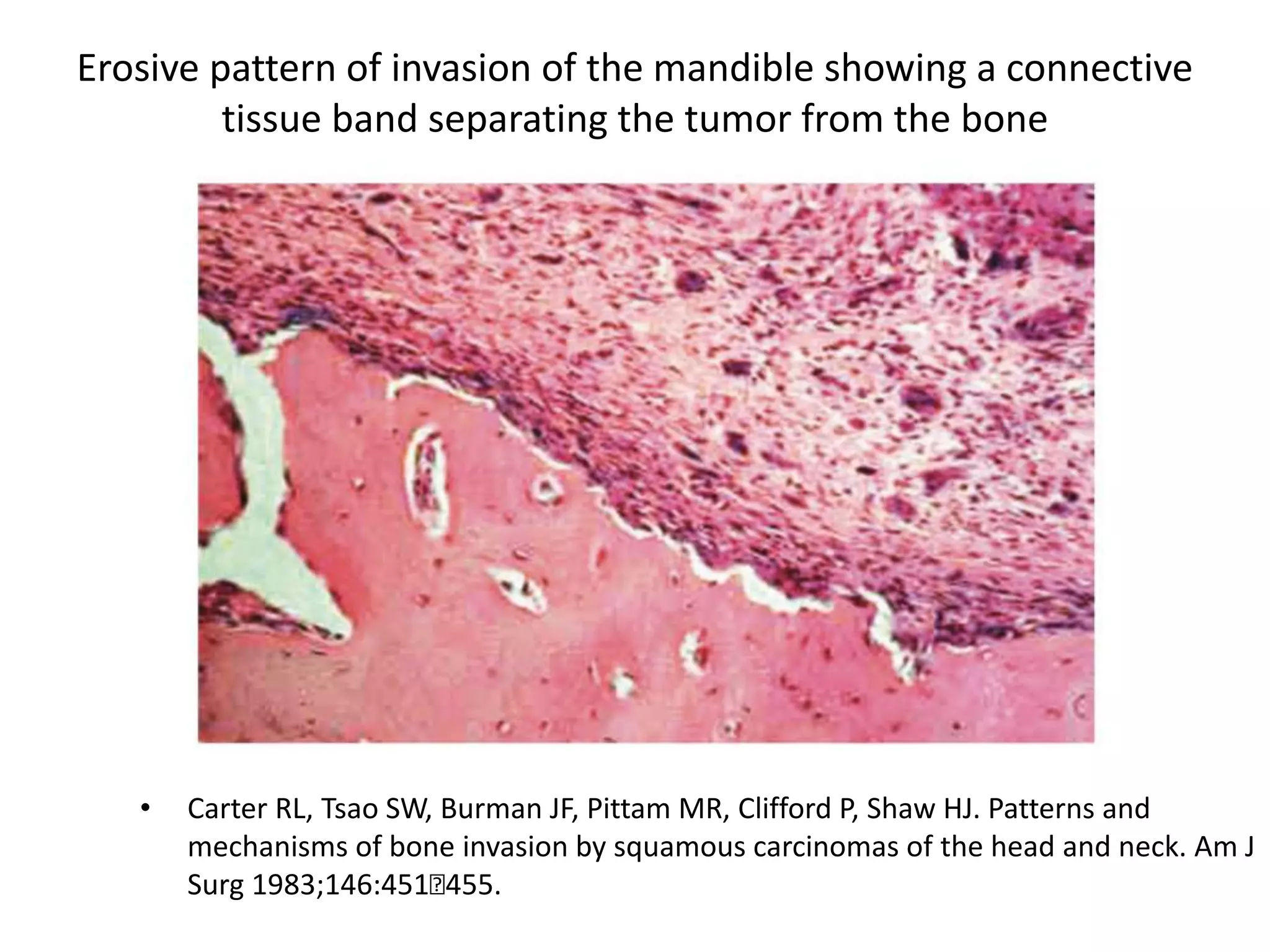 Pattern of Mandibular invasion | PPTX