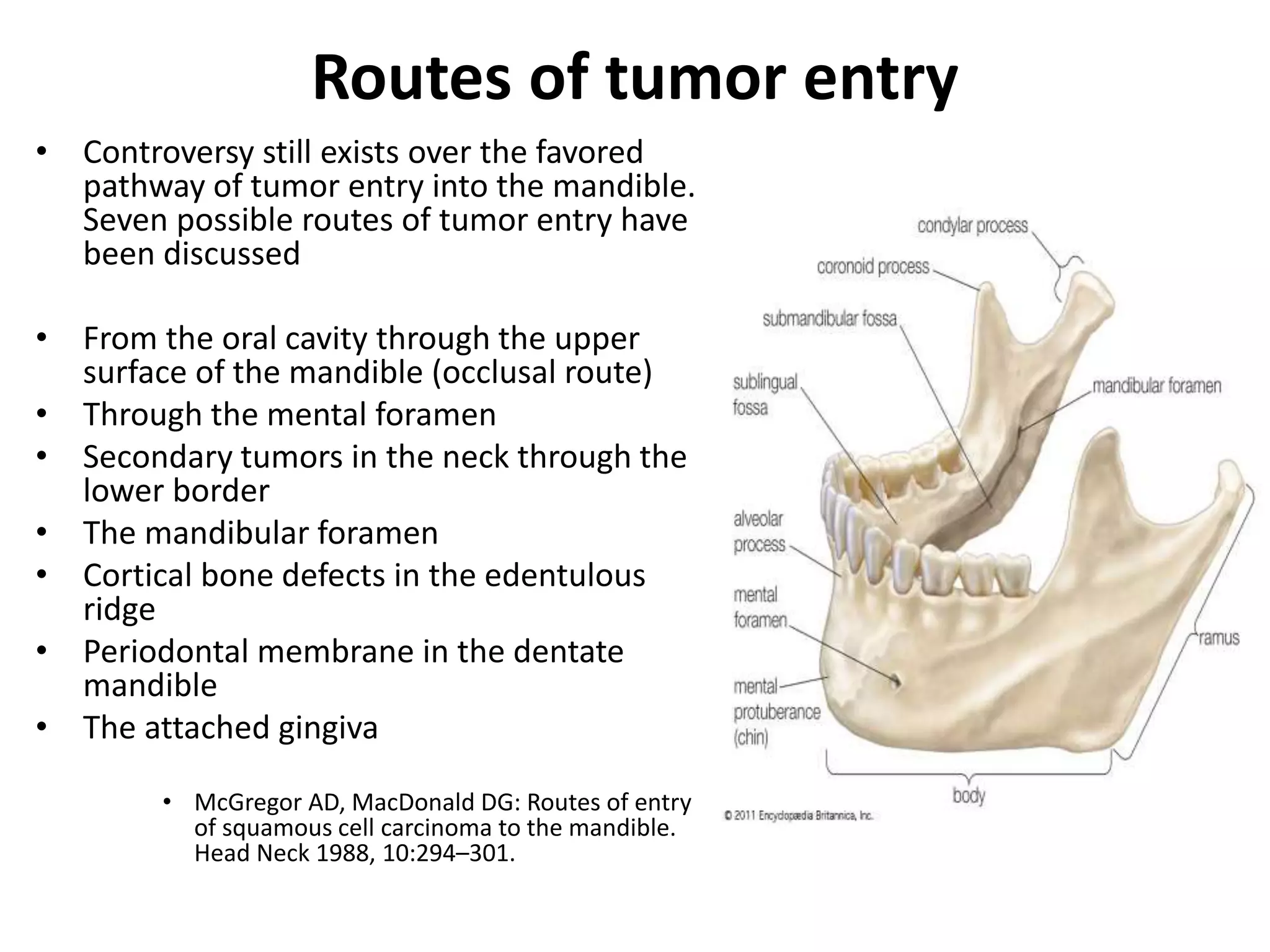 Pattern of Mandibular invasion | PPTX