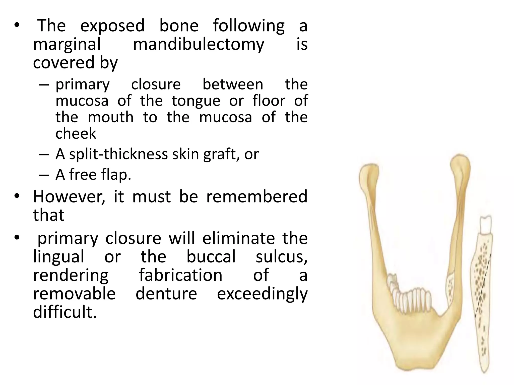 Pattern of Mandibular invasion | PPTX
