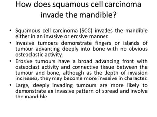 Pattern of Mandibular invasion | PPTX