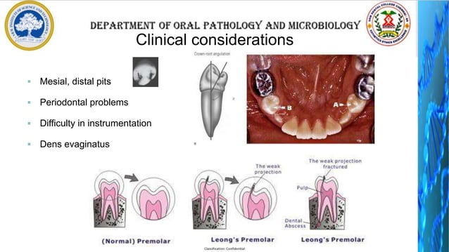 Mandibular I premolar | PPT