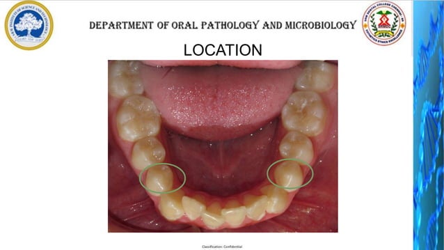 Mandibular I premolar | PPT