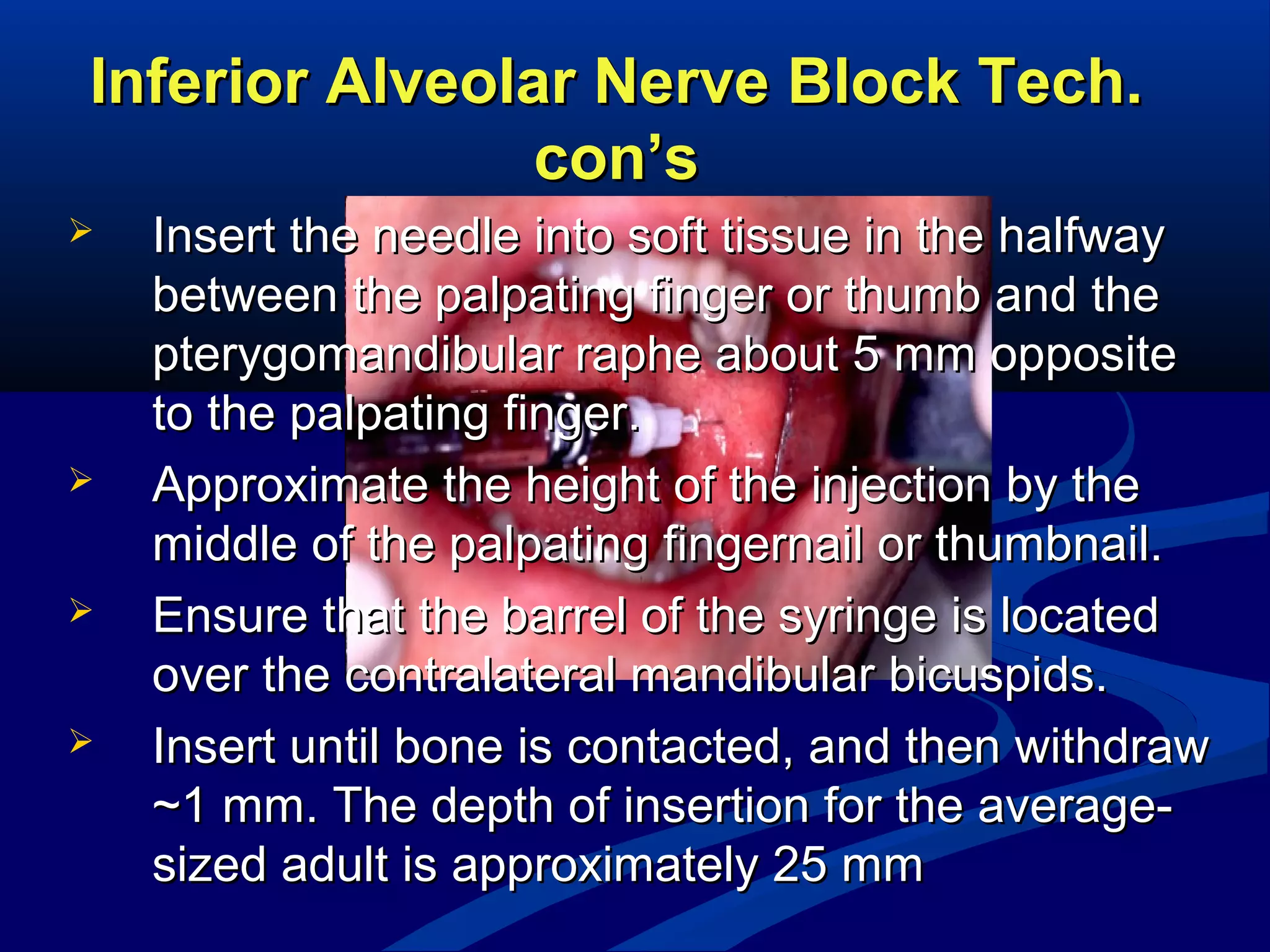 Mandibular Local Anesthesia | PPT