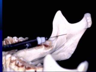 Mandibular Local Anesthesia | PPT