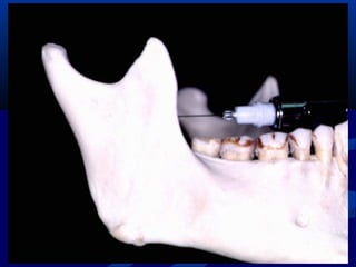 Mandibular Local Anesthesia | PPT