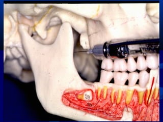 Mandibular Local Anesthesia | PPT